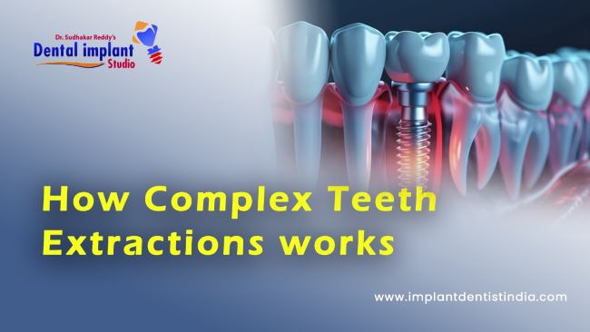 Complex Teeth Extractions in Bangalore | Painless Procedures